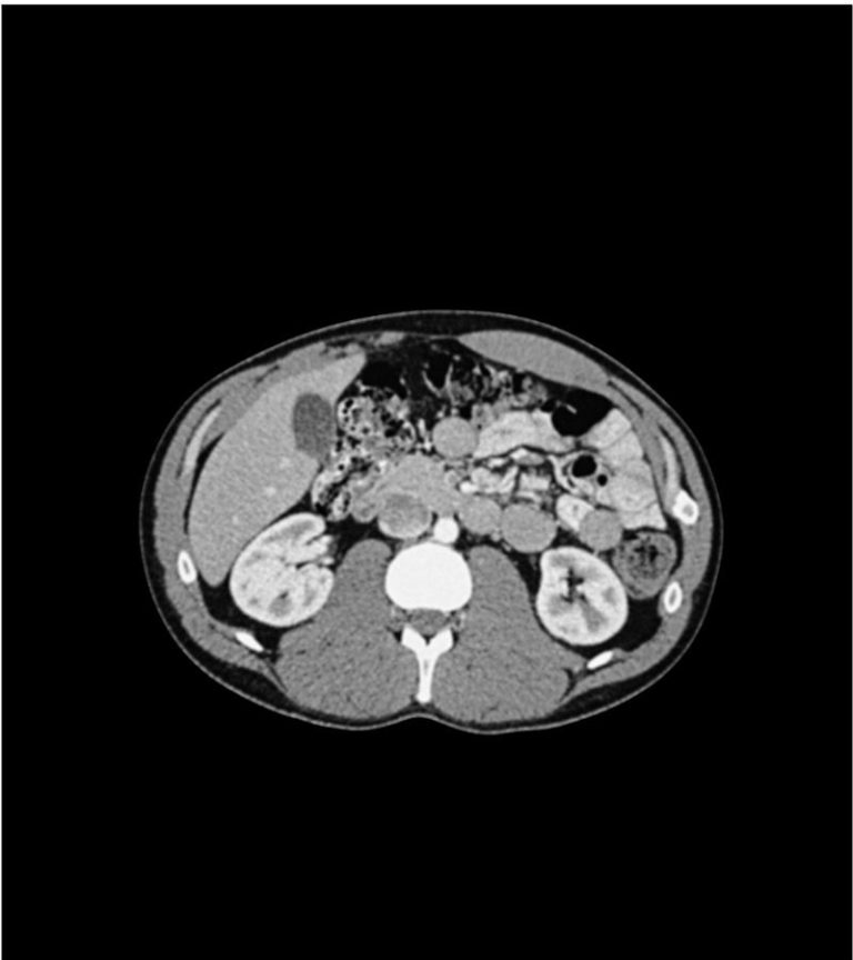 Abdomen CT Phantom - Portal Venous