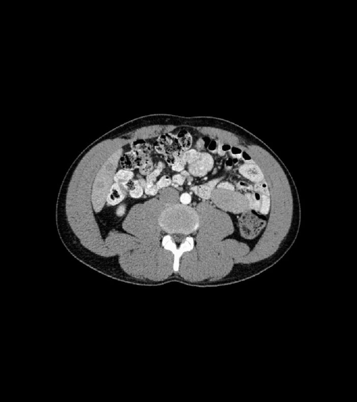 Abdomen CT Phantom - Low-Contrast Spheres