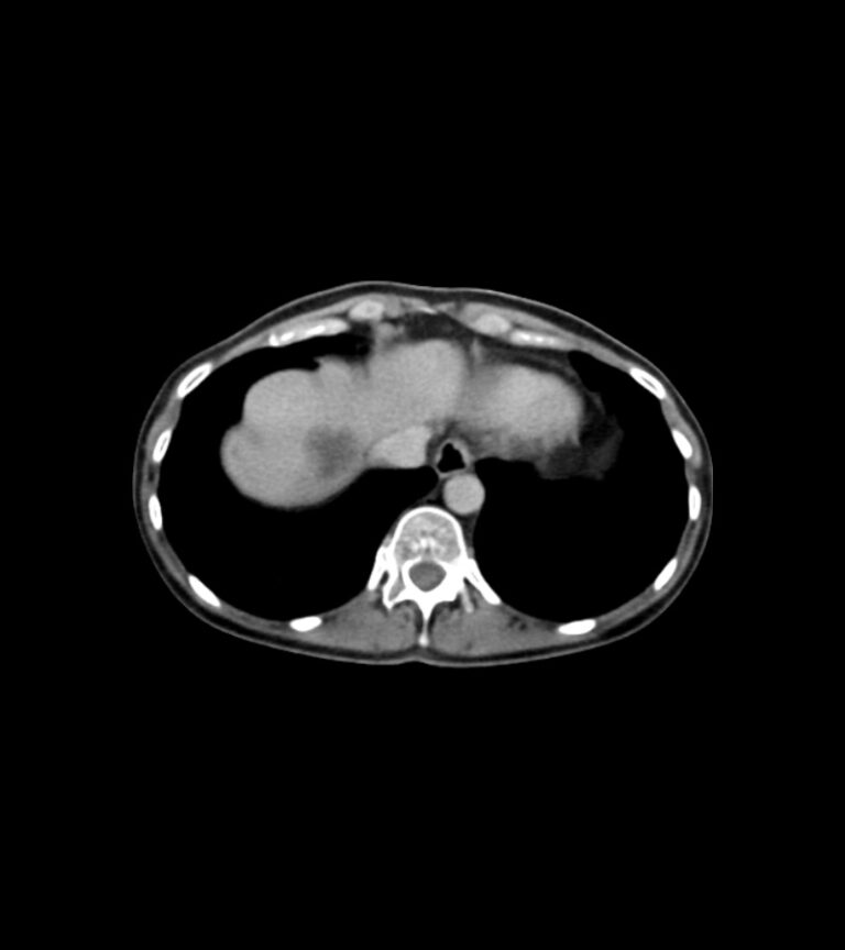 Abdomen CT Phantom - Liver Metastases